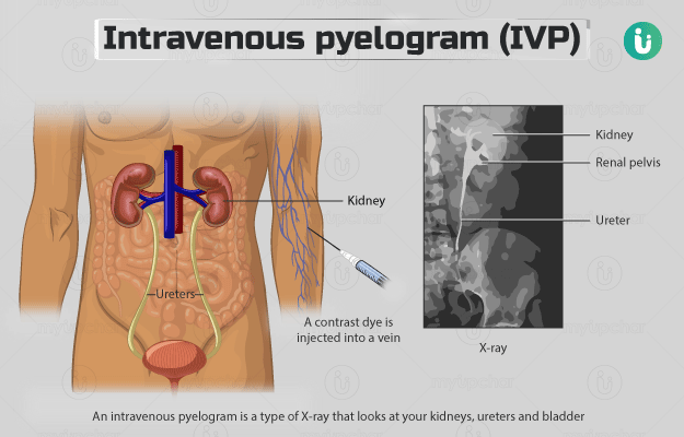Intravenous Urography Ivu And Intravenous Pyelogram Ivp 60 Off